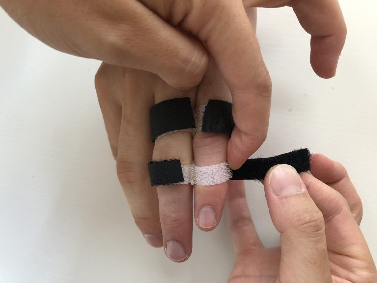 Syndactylie - Institut d'appareillage