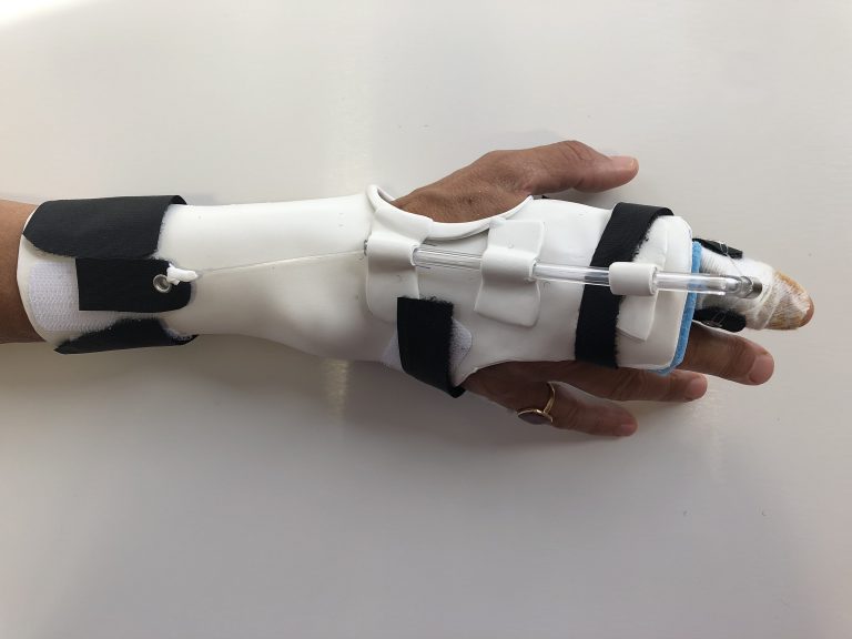 Orthèses Dynamiques - Institut d'appareillage